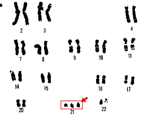 Difference Between Trisomy And Triploidy Definition Facts Examples And Differences