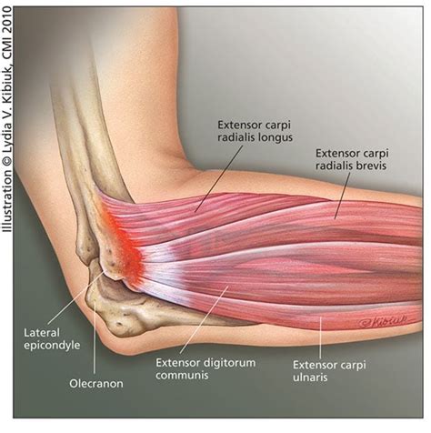 Tennis Elbow−lateral Epicondylitis−wellness And Treatment Hss