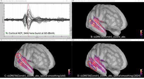 Eeg Spatial Smoothing Comparison Discussions Brainstorm