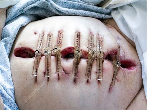 Retention Sutures In Laparotomy Stock Image C0300099 Science