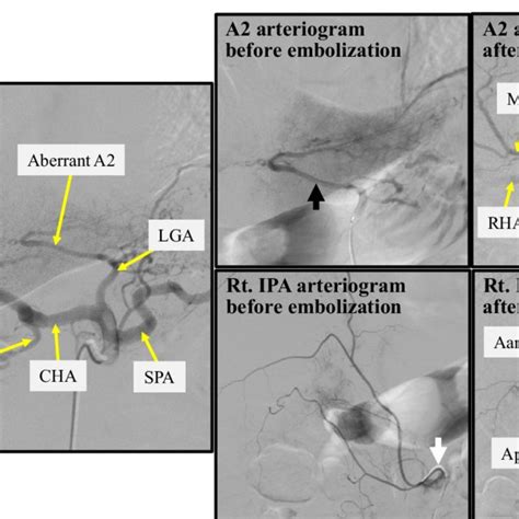 Preoperative Hepatic Arterial Embolization Immediately After Download Scientific Diagram