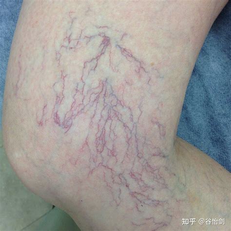 女性腿部毛细血管扩张可能是什么原因导致？ 知乎