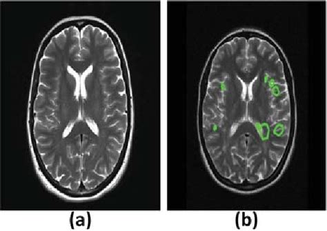 Figure From Non Subsampled Shearlet Entropy And Logistic Regression Based Multiple Sclerosis