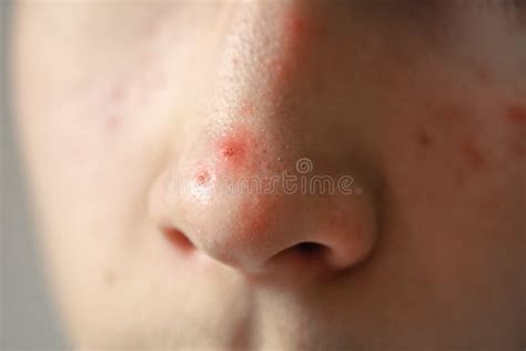 Red Pimple On Nose