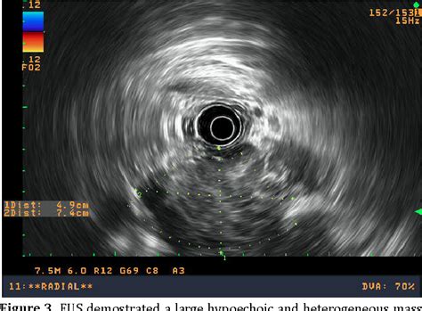 Figure 1 From Aids Related Pancreatic Burkitts Lymphoma Eus Fna