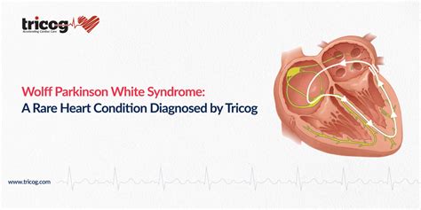 Wolff Parkinson White Syndrome 54 Off Brunofugaadvbr
