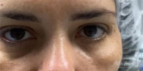 Secuelas Oculares De La Parálisis Facial Diagnóstico Y Tratamiento
