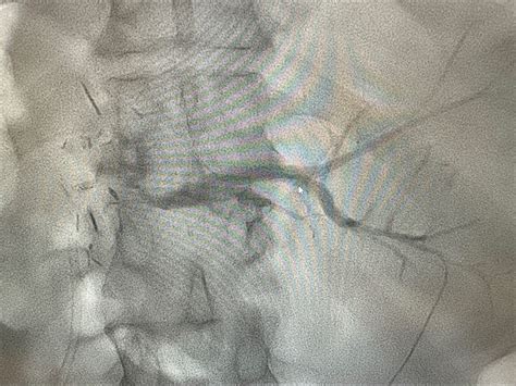 Job Oldenziel On Linkedin Patiënt With Hemihepatectomy On The Right Side For Hcc 65 Yr Old Male…