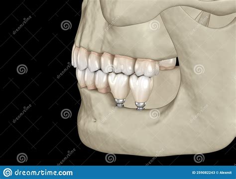 Implantation With Mini Implants In To Recessed Jaw Bone Medically