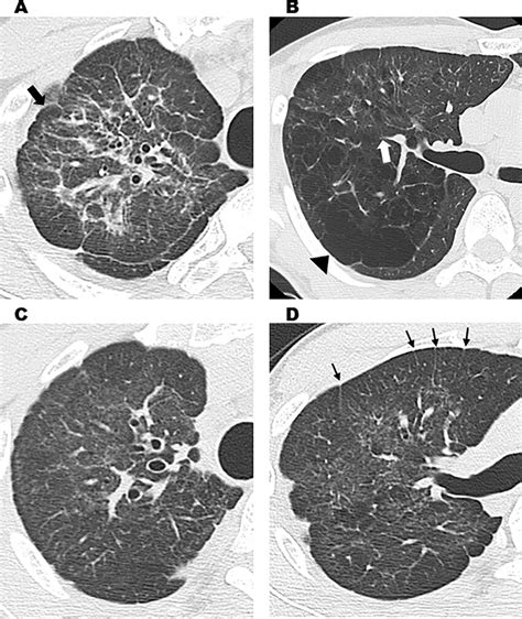 Chest Hrct Of Case 1 A Hrct Image Case 1 Severe Central Fibrosis Download Scientific