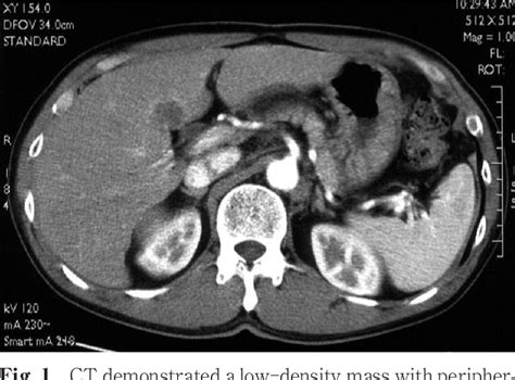 Figure 1 From Repeat Hepatectomy For Intrahepatic Recurrence Of Cholangiolocellular Carcinoma