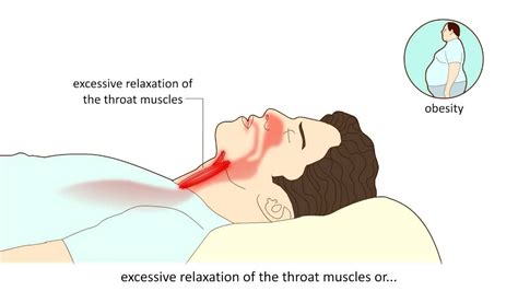 Obstructive Sleep Apnea Syndrome Osas Causes And Treatment Youtube