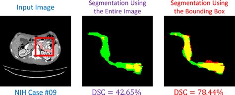 Figure 1 From Pancreas Segmentation In Abdominal Ct Scan A Coarse To Fine Approach Semantic