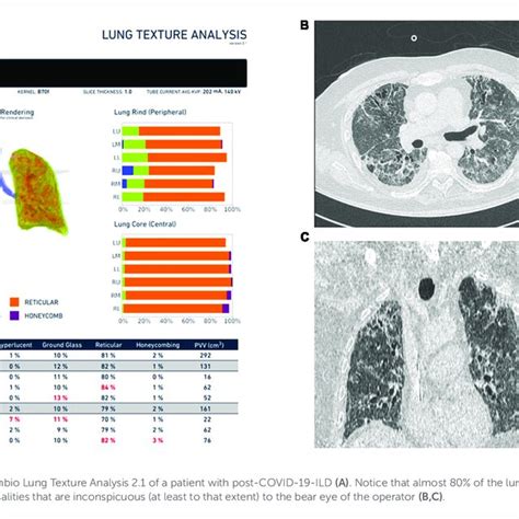 Radiographic Features At The 3 Month Follow Up Based On Imbio Lung