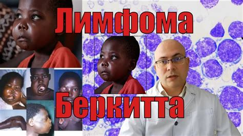 Лимфома Беркитта прогноз симптомы у детей и взрослых Youtube