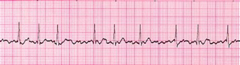 Ecg Interpretation Flashcards Quizlet