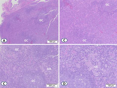 selected hande sections of typical lymph node architecture in acute ebv