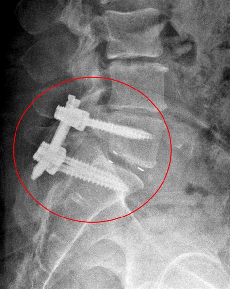 Back Brace After Tlif Surgery At Lawrence Melson Blog