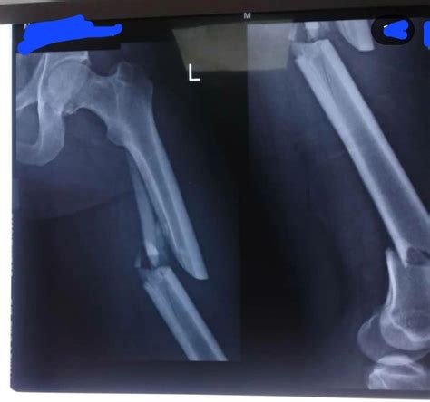 Mohammed Abdulal Hamad On Linkedin Segmental Femur Shaft Fracture 33