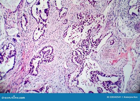 Teratoma Or Dermoid Cyst Generative Ai Illustration 277728349