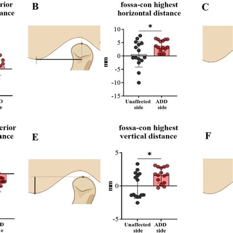 positional differences in condyle and disc between add and unaffected