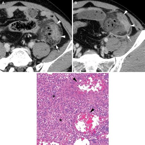 Perforated Diverticulitis In The Descending And Sigmoid Colon Of A Download Scientific Diagram