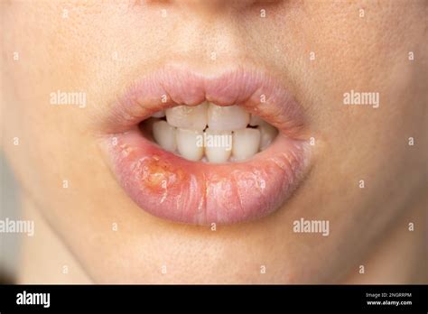 Rash Under Lip