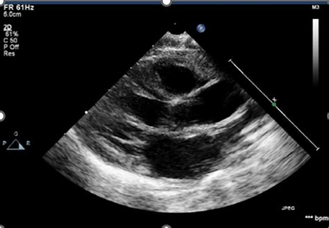 Transthoracic Echo Parsternal Long Axis View Shows Recovered Lv Download Scientific Diagram