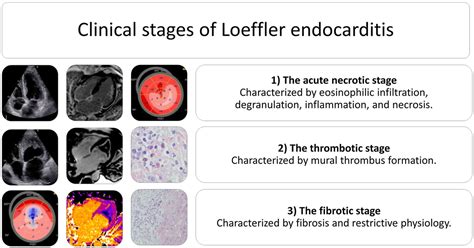 Two Different Clinical Presentations And Stages Of Loeffler