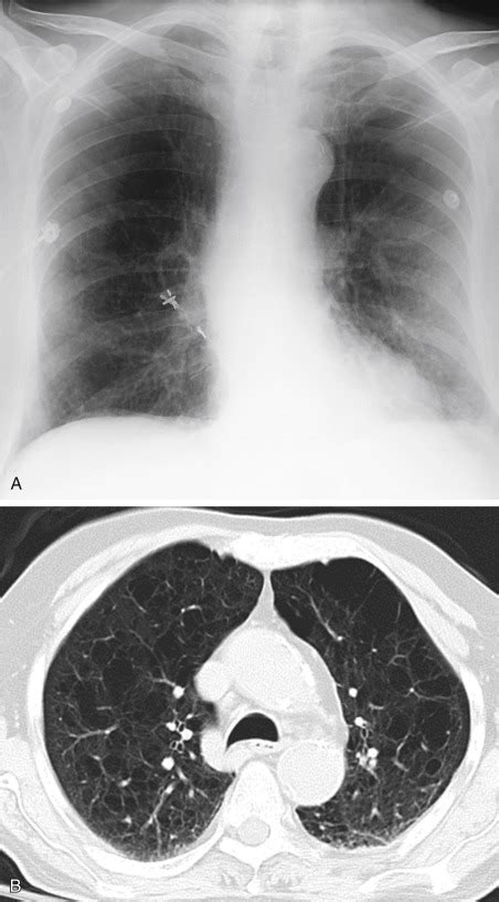 Hyperlucent Thorax Radiology Key