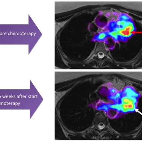 Representative Ptld Patient For Each Morphological Subtype With Suv Download Scientific Diagram