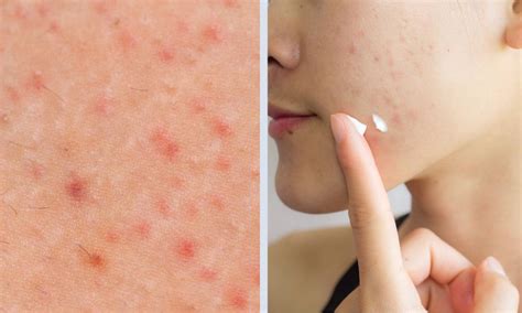 Fungal Folliculitis Legs