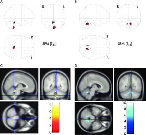 Maps Of The T Value Voxel Analysis At P005 Corrected For Multiple Download Scientific