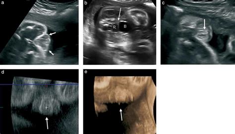 Diagnostic Approach In Prenatally Detected Genital Abnormalities