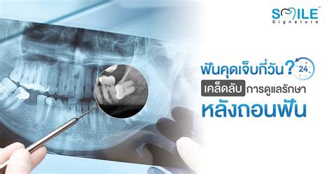 ผ่าฟันคุดเจ็บกี่วัน เคล็ดลับการดูแลรักษาหลังถอนฟัน สไมล์ ซิกเนเจอร์