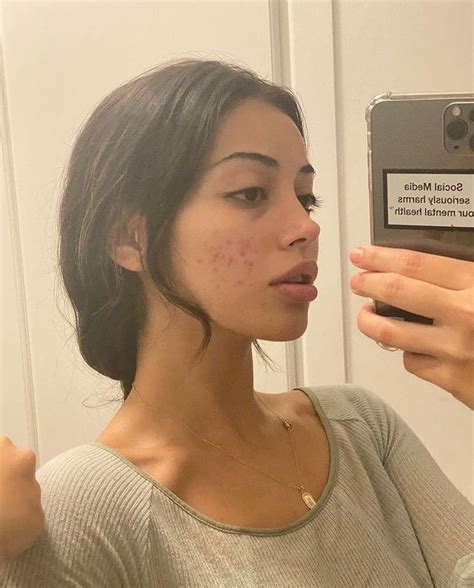 Pin By Rukiye Özkan On See Girl With Acne Cindy Kimberly Pretty Skin