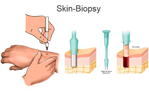 Jaju Skin Biopsy Hospital And Health