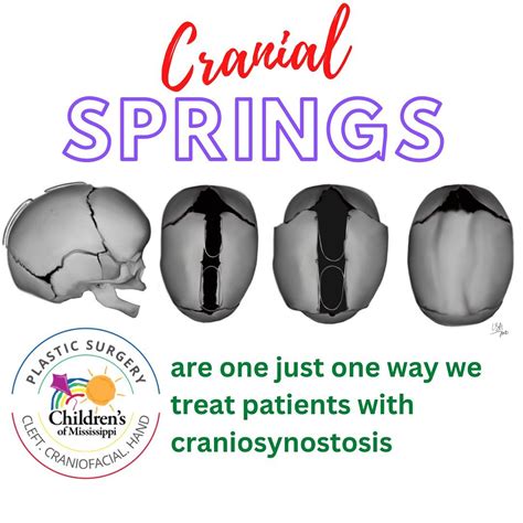 Strip Craniectomy And Cranial Expansion With Springs Is A Minimally Invasive And Active Approach
