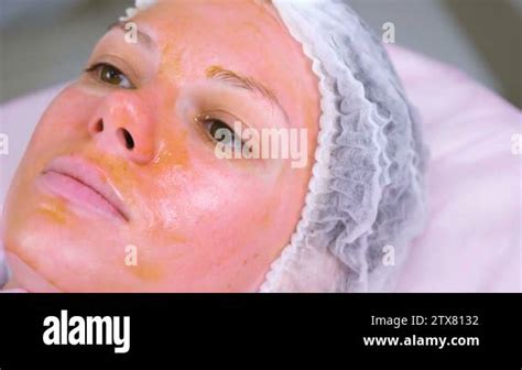 Chemical Peeling O The Womans Face Cleaning The Face Skin And