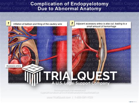 Complication Of Endopyelotomy Due To Abnormal Anatomy Trial Exh