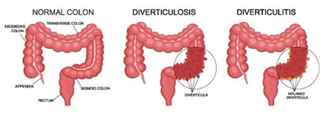 Could Your Belly Pain Be Diverticulitis Lexington Medical Center