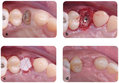 Volumetric Evaluation Of Alveolar Ridge Preservation Using Dense Ptfe