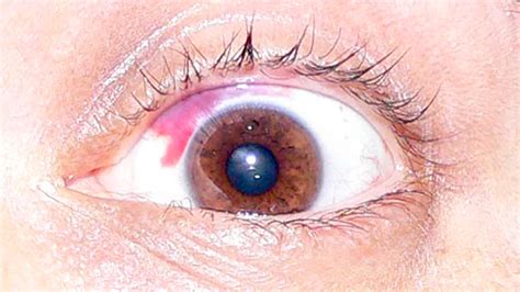 What Causes Red Spots Around Eyes After Vomiting