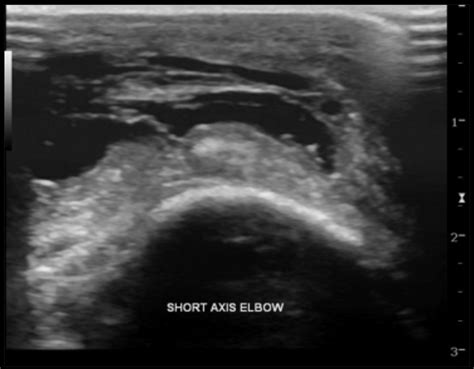 Emergency Medicine Educationseptic Bursitis Ed