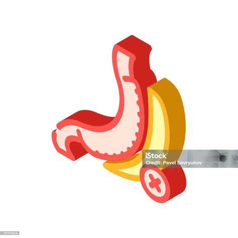 위 절제술 수술 아이소 메트릭 아이콘 벡터 일러스트 레이 션 3차원 형태에 대한 스톡 벡터 아트 및 기타 이미지 3차원 형태 건강관리와 의술 공격성 Istock