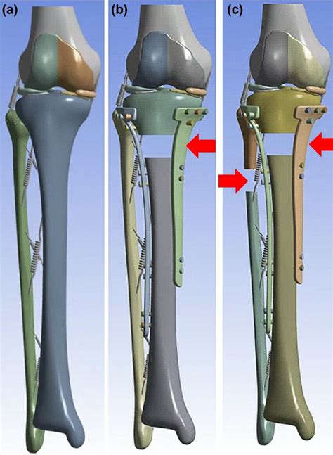 The Tibia Fracture Plate Model With And Without Pfo A The Intact