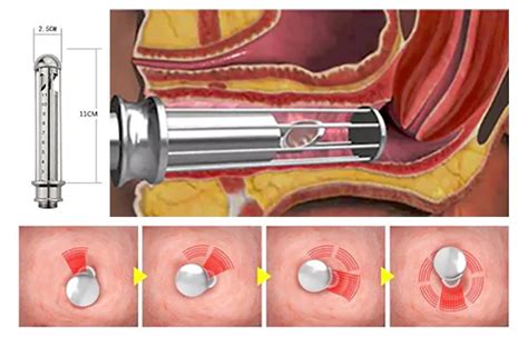 Medspa Classic Treatment Carbon Dioxide Fractional Laser Stelle Laser