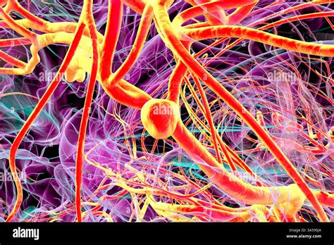 Illustration Of A Saccular Berry Aneurysm On A Brain Artery