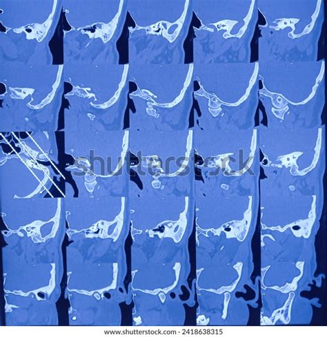 Ct Scan Temporal Bones Showing Picture Stock Photo 2418638315 Shutterstock