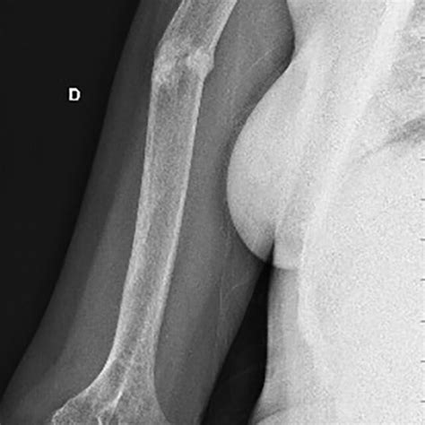 Right Side Humerus X‐rays Previous Pseudarthrosis Download Scientific Diagram